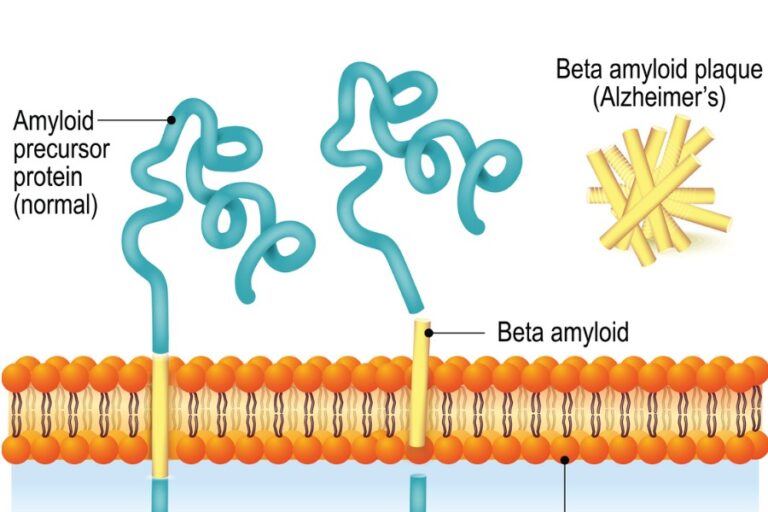 Amyloid beta plaques and treatments for Alzheimer’s disease.
